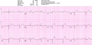 ST elevation in aVR, STEMI equivalent? | ECG Cases| Emergency Medicine ...