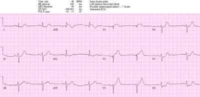ST elevation in aVR, STEMI equivalent? | ECG Cases| Emergency Medicine ...
