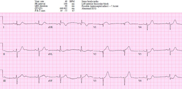 ST elevation in aVR, STEMI equivalent? | ECG Cases| Emergency Medicine ...