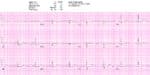 ST elevation in aVR, STEMI equivalent? | ECG Cases| Emergency Medicine ...