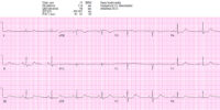 ST elevation in aVR, STEMI equivalent? | ECG Cases| Emergency Medicine ...