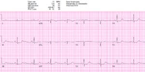 ST elevation in aVR, STEMI equivalent? | ECG Cases| Emergency Medicine ...