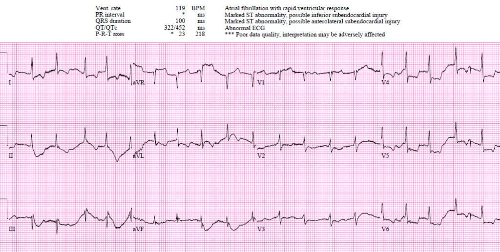 ST elevation in aVR, STEMI equivalent? | ECG Cases| Emergency Medicine ...