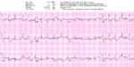 ST elevation in aVR, STEMI equivalent? | ECG Cases| Emergency Medicine ...