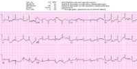 ST elevation in aVR, STEMI equivalent? | ECG Cases| Emergency Medicine ...