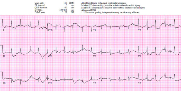 ST elevation in aVR, STEMI equivalent? | ECG Cases| Emergency Medicine ...