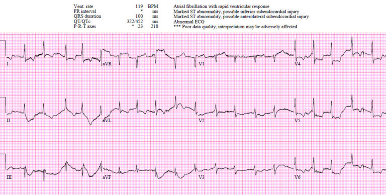 ST elevation in aVR, STEMI equivalent? | ECG Cases| Emergency Medicine ...