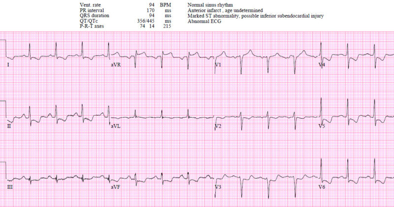 ST elevation in aVR, STEMI equivalent? | ECG Cases| Emergency Medicine ...