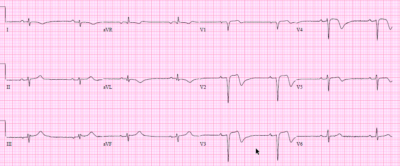 ST elevation in aVR, STEMI equivalent? | ECG Cases| Emergency Medicine ...