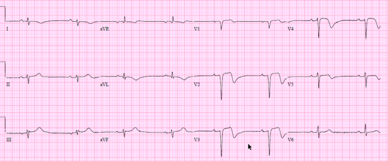 ST elevation in aVR, STEMI equivalent? | ECG Cases| Emergency Medicine ...