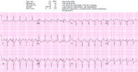 ST elevation in aVR, STEMI equivalent? | ECG Cases| Emergency Medicine ...