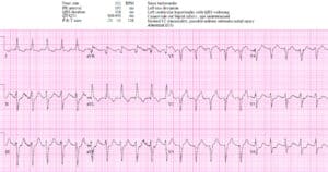 ST elevation in aVR, STEMI equivalent? | ECG Cases| Emergency Medicine ...