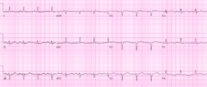 ST elevation in aVR, STEMI equivalent? | ECG Cases| Emergency Medicine ...