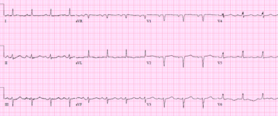 ST elevation in aVR, STEMI equivalent? | ECG Cases| Emergency Medicine ...