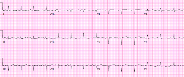 ST elevation in aVR, STEMI equivalent? | ECG Cases| Emergency Medicine ...