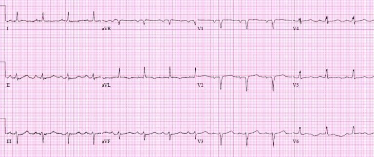 ST elevation in aVR, STEMI equivalent? | ECG Cases| Emergency Medicine ...