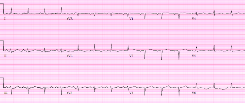 ST elevation in aVR, STEMI equivalent? | ECG Cases| Emergency Medicine ...