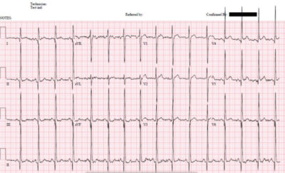 Cardiac syncope ECG Interpretation | ECG cases | EM Cases