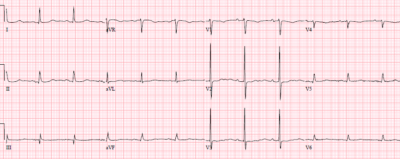 Posterior MI | ECG cases 6 | Emergency Medicine Cases