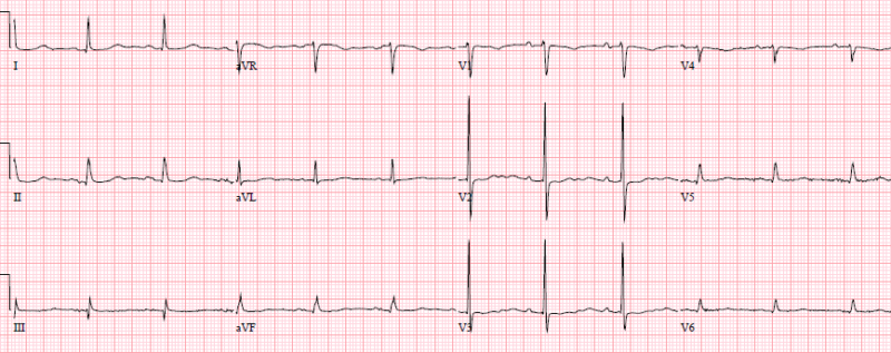 Posterior MI | ECG cases 6 | Emergency Medicine Cases