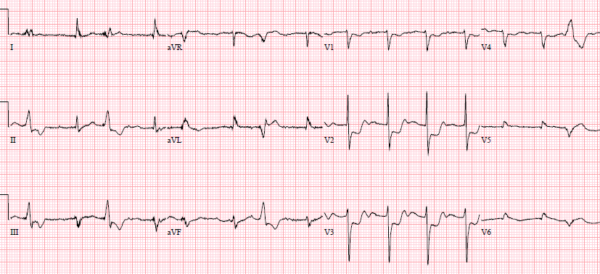 Posterior MI | ECG cases 6 | Emergency Medicine Cases