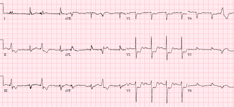 Posterior MI | ECG cases 6 | Emergency Medicine Cases