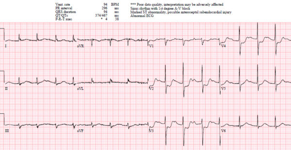 Posterior MI | ECG cases 6 | Emergency Medicine Cases