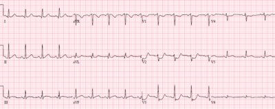Posterior MI | ECG cases 6 | Emergency Medicine Cases
