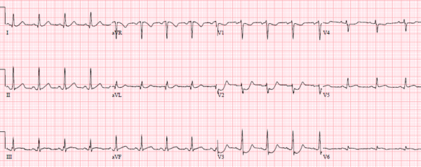 Posterior MI | ECG cases 6 | Emergency Medicine Cases