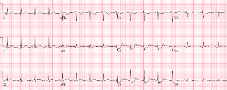 Posterior MI | ECG cases 6 | Emergency Medicine Cases