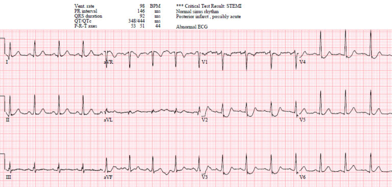 Posterior MI | ECG cases 6 | Emergency Medicine Cases
