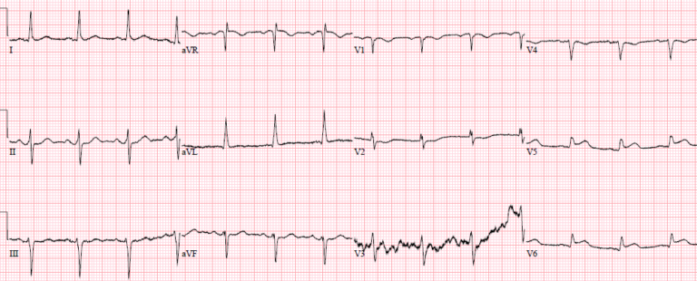 Posterior MI | ECG cases 6 | Emergency Medicine Cases