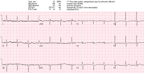 Posterior MI | ECG cases 6 | Emergency Medicine Cases