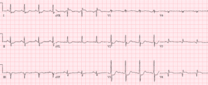 Posterior MI | ECG cases 6 | Emergency Medicine Cases