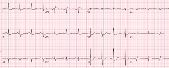Posterior MI | ECG cases 6 | Emergency Medicine Cases