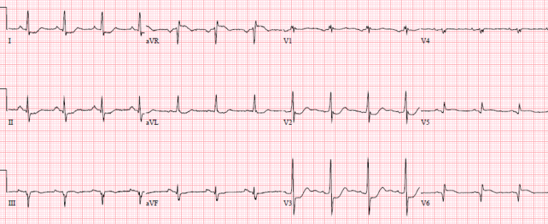 Posterior MI | ECG cases 6 | Emergency Medicine Cases