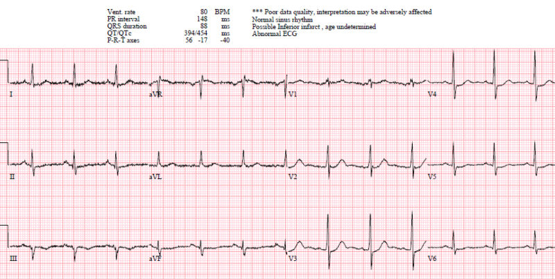 Posterior MI | ECG cases 6 | Emergency Medicine Cases