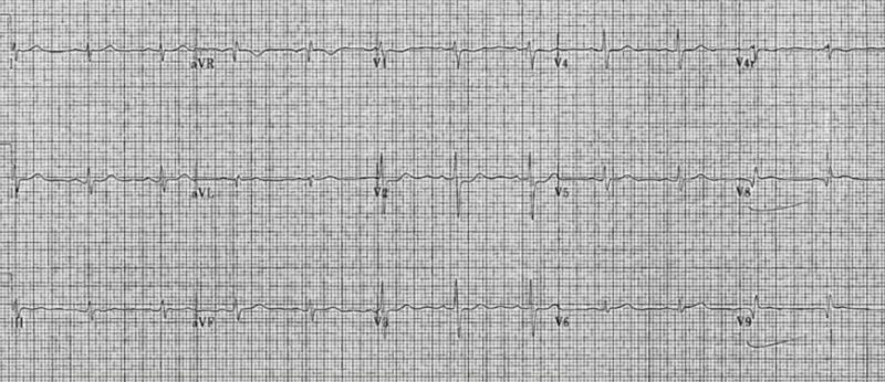 Posterior MI | ECG cases 6 | Emergency Medicine Cases