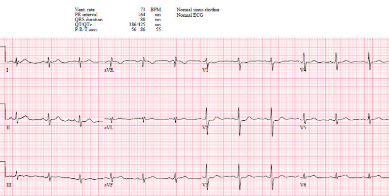 Posterior MI | ECG cases 6 | Emergency Medicine Cases
