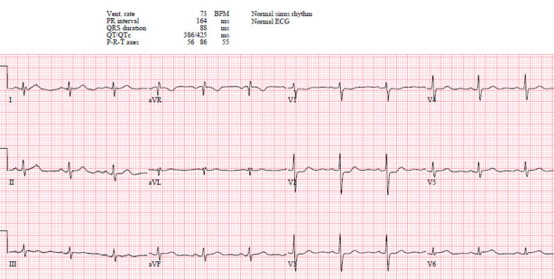 Posterior MI | ECG cases 6 | Emergency Medicine Cases
