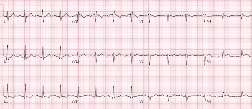 Posterior MI | ECG cases 6 | Emergency Medicine Cases