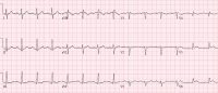 Posterior MI | ECG cases 6 | Emergency Medicine Cases