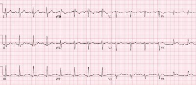 Posterior MI | ECG cases 6 | Emergency Medicine Cases
