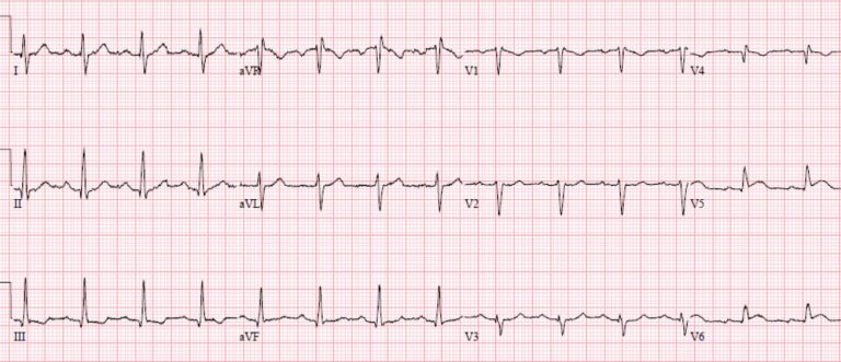 Posterior MI | ECG cases 6 | Emergency Medicine Cases