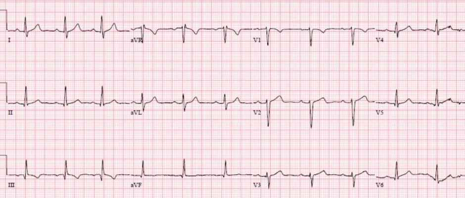 Posterior MI | ECG cases 6 | Emergency Medicine Cases