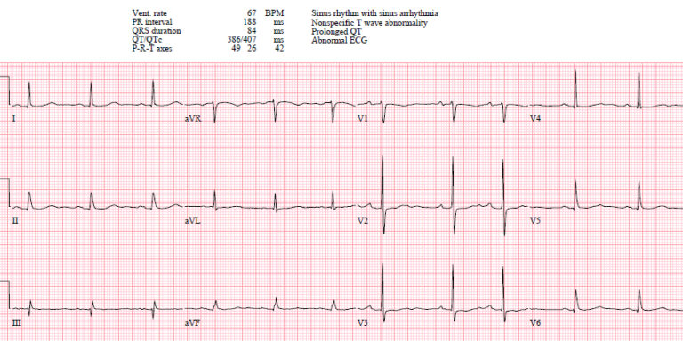 Posterior MI | ECG cases 6 | Emergency Medicine Cases