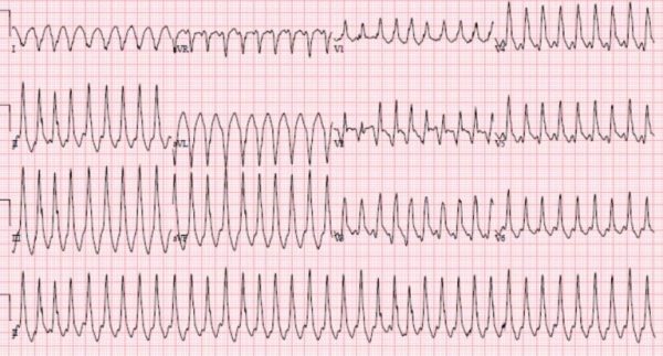 Cardiac syncope ECG Interpretation | ECG cases | EM Cases