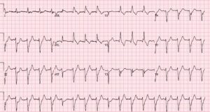 Cardiac syncope ECG Interpretation | ECG cases | EM Cases