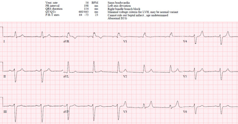 Cardiac syncope ECG Interpretation | ECG cases | EM Cases
