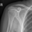 Shoulder Injuries - Approach & Dislocations | Emergency Medicine Cases